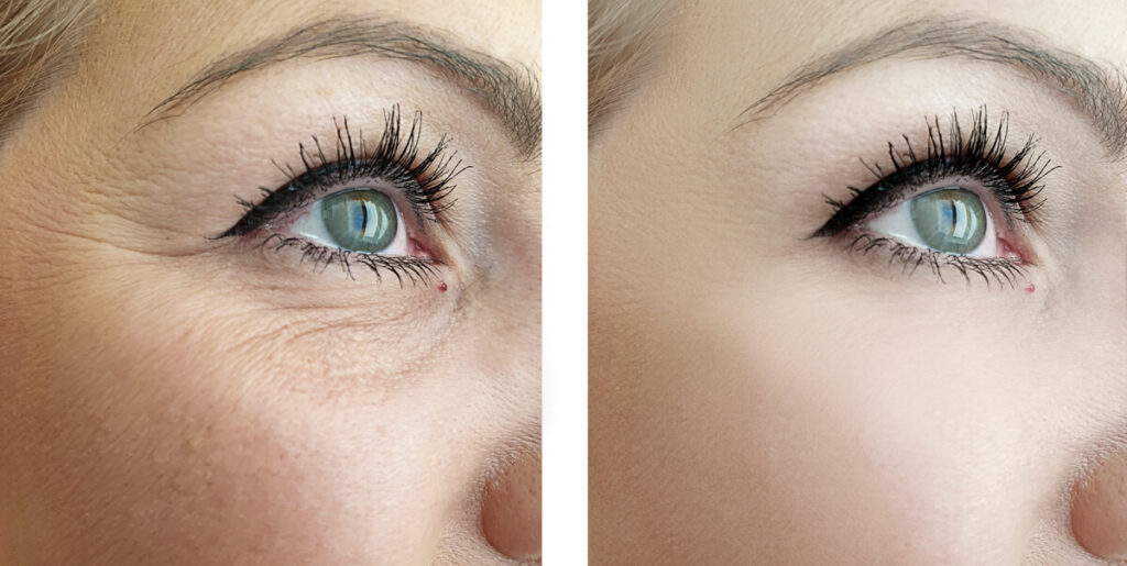 Facial Aesthetics in Dedham, Ma. - Fotona Smooth Laser Treatments